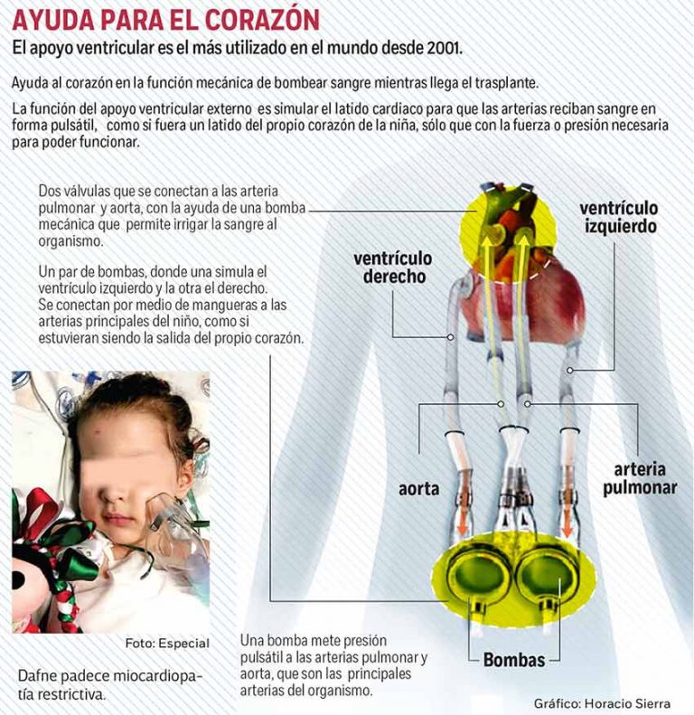 Colocan en México primer implante de corazón artificial a niña de 4 ...